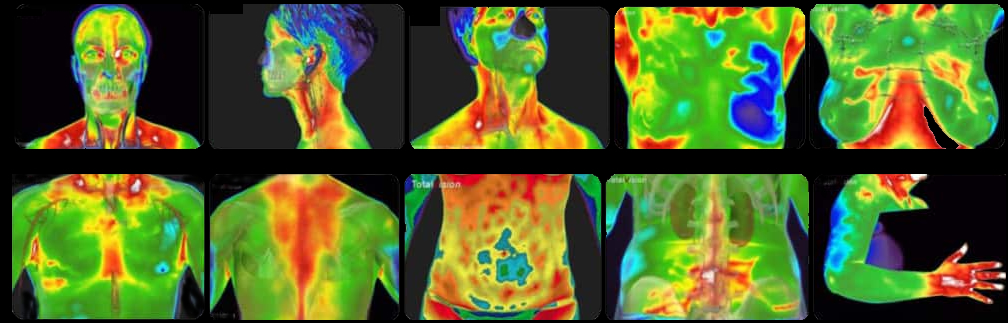 What is Medical Thermography - Institute for the Advancement of Medical ...